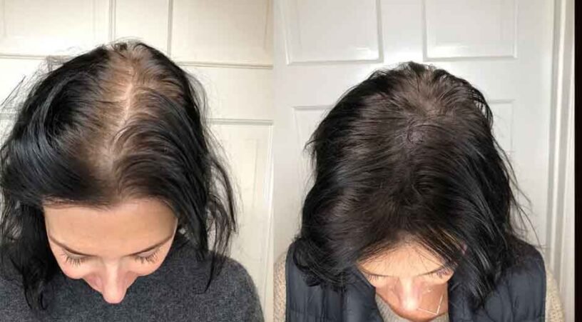 How Scalp Micropigmentation Can Transform Your Hairline